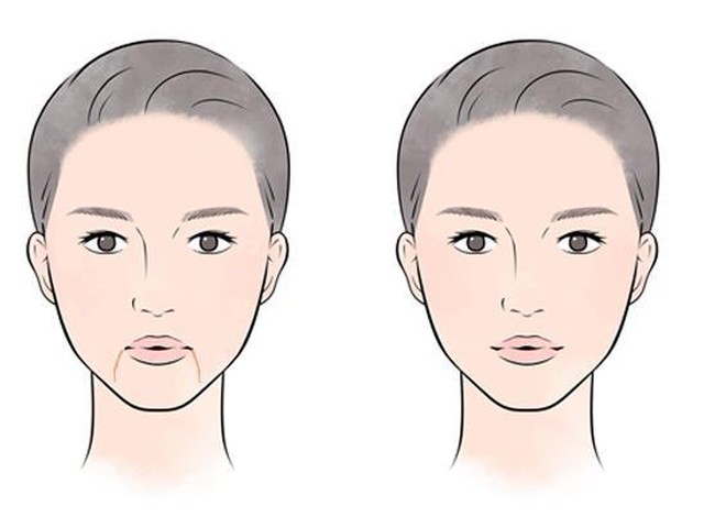 口角から下に伸びる深い溝「マリオネットライン」攻略法（HALMEK up）